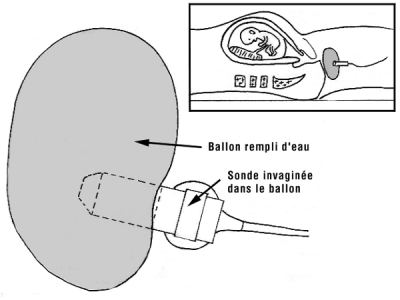 Icono 2 (Echographie du col utérin)