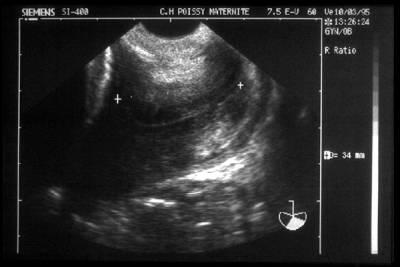 Icono 5 (Echographie du col utérin)