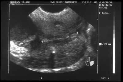 Icono 10 (Echographie du col utérin)
