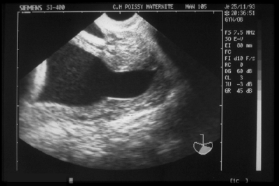 Icono 17 (Echographie du col utérin)